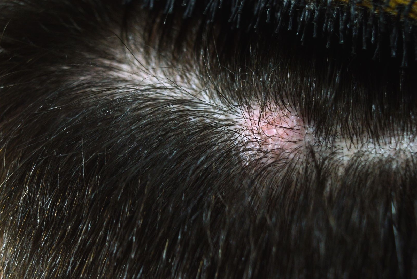 Understanding the Role of Scalp Health in Hair Restoration - Fabulous ...